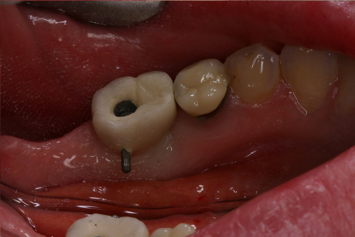 Dental Implant Case Study | Dr Zielinski & Associates