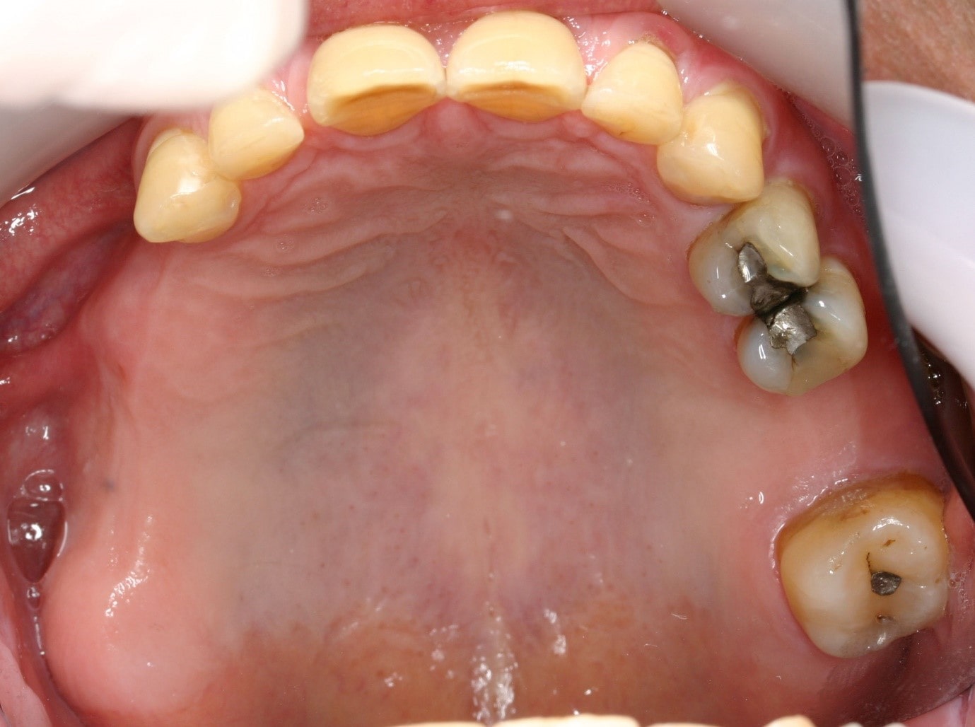 Posterior bridge and single molars | Dr Zielinski & Associates