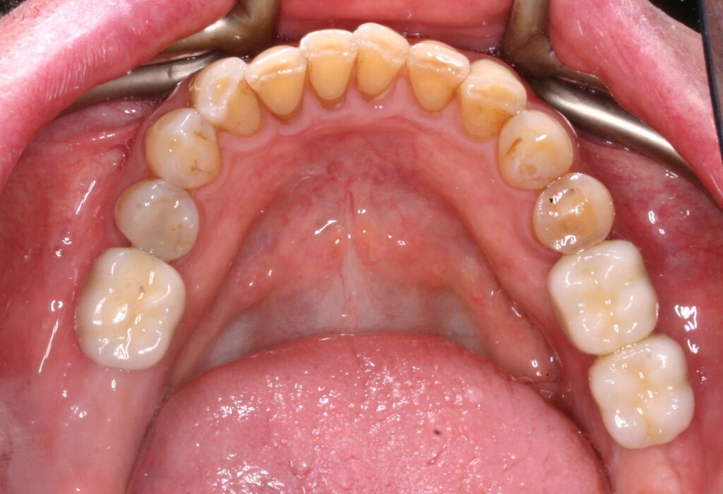 Posterior bridge and single molars | Dr Zielinski & Associates